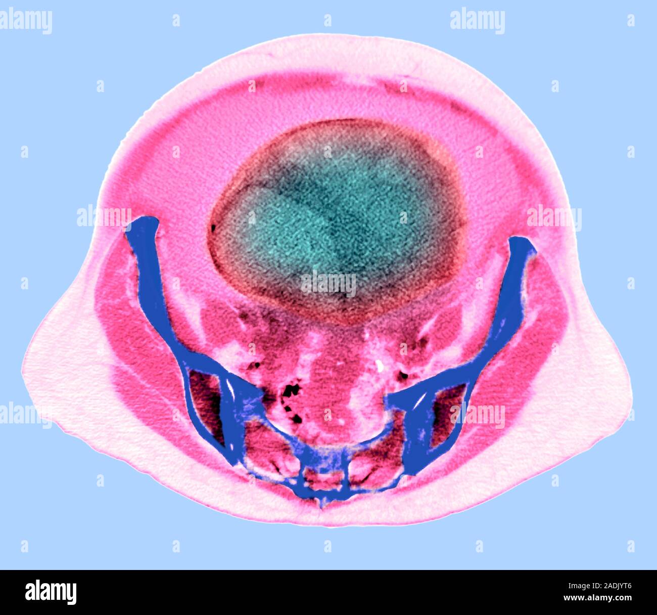 Ovarian cancer. Coloured computed tomography (CT) scan of an axial ...
