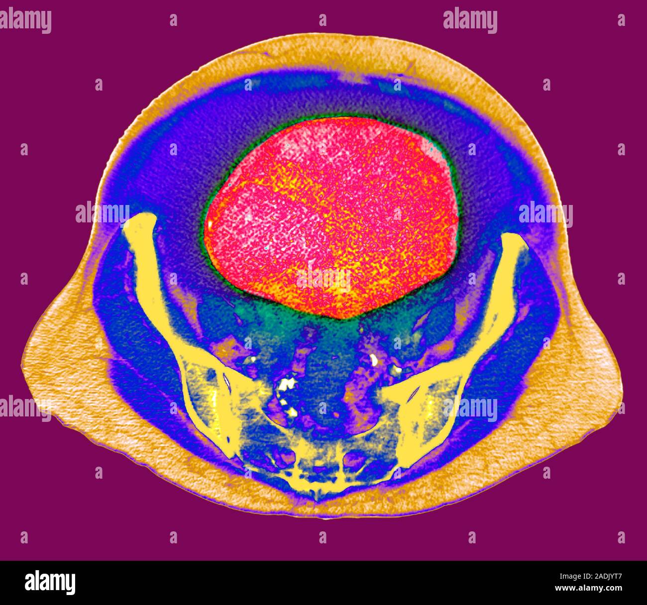 Ovarian cancer. Coloured computed tomography (CT) scan of an axial ...