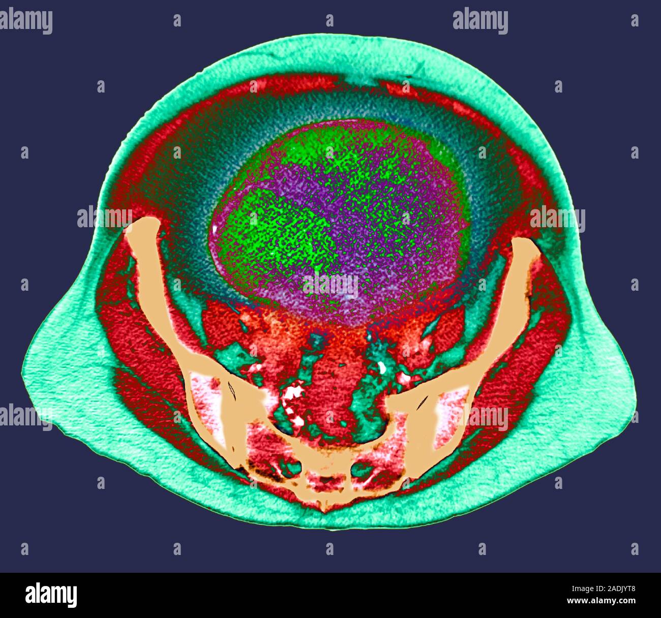 Ovarian cancer. Coloured computed tomography (CT) scan of an axial section through the pelvic ...