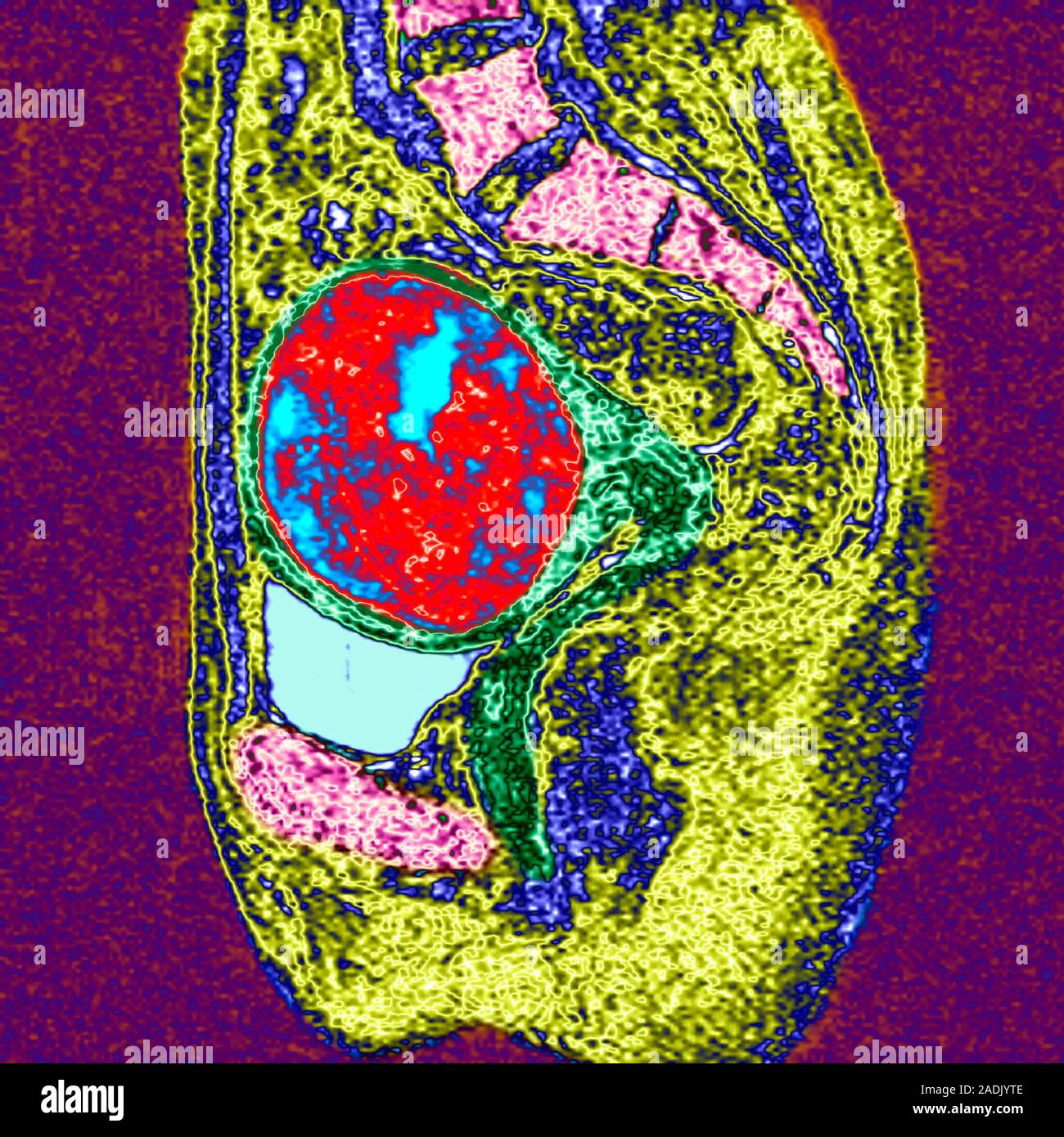 Uterine fibroid. Coloured magnetic resonance imaging (MRI) scan of a ...