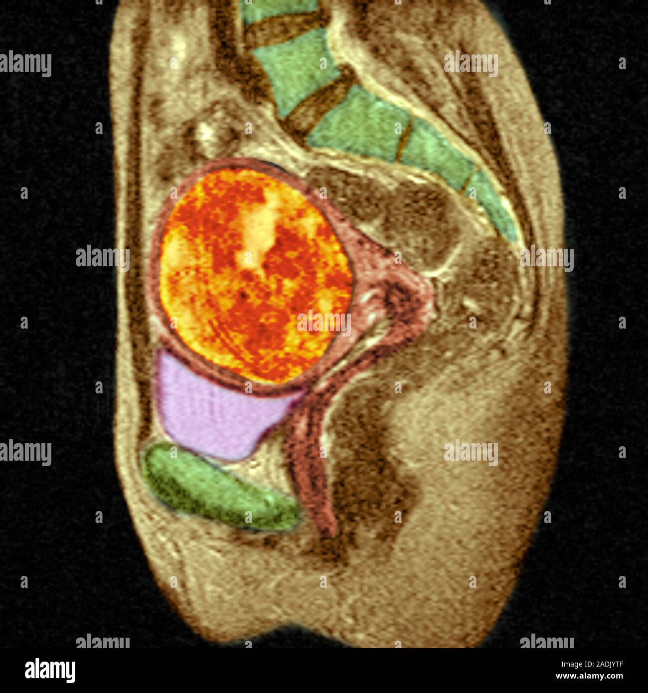 Uterine Fibroid Coloured Magnetic Resonance Imaging Mri Scan Of A Sagittal Sideways Section