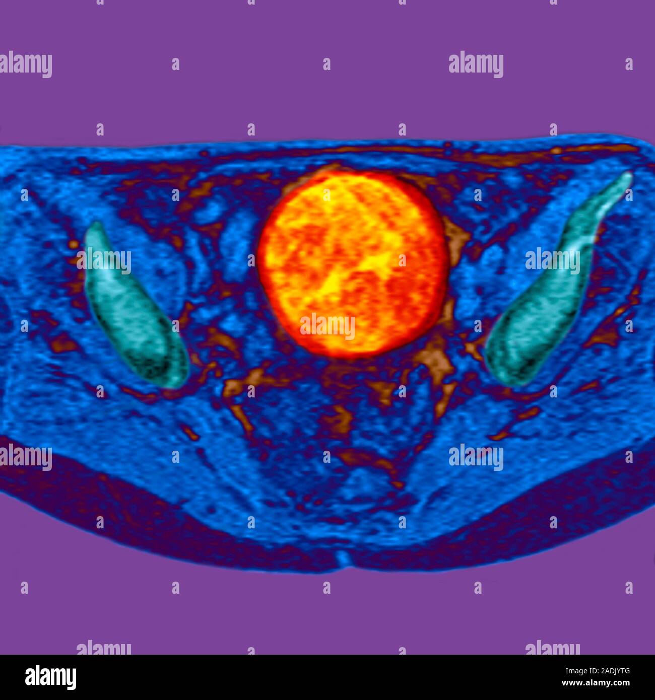 Uterine fibroid. Coloured magnetic resonance imaging (MRI) scan of a ...