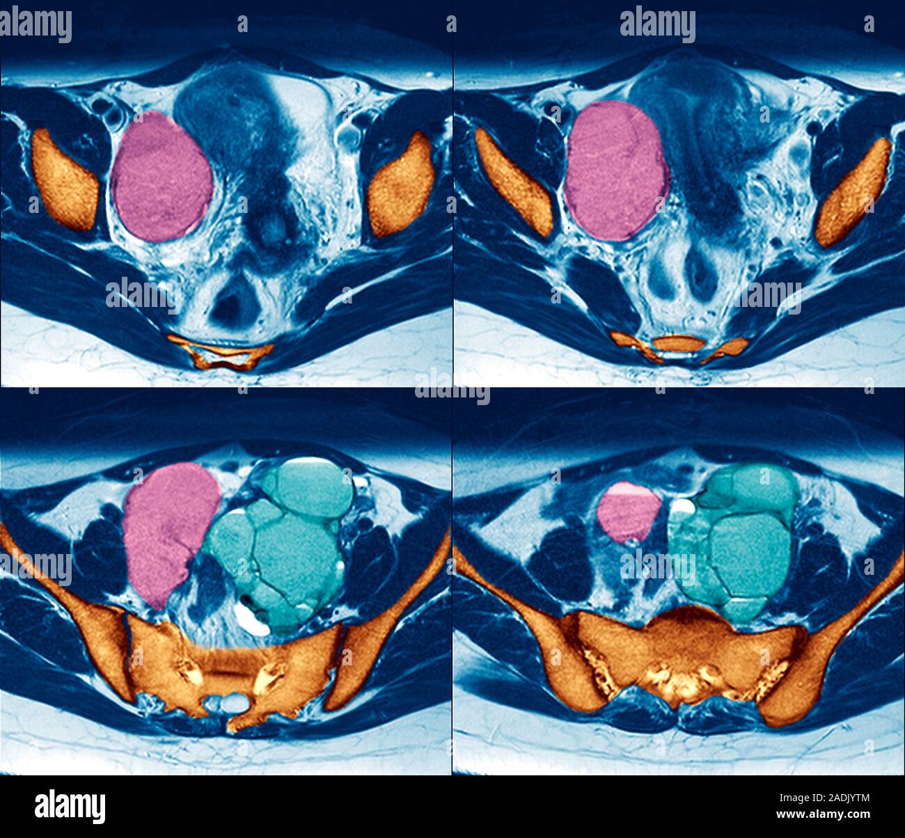 Endometriosis and ovarian cyst, sequence of axial magnetic resonance ...