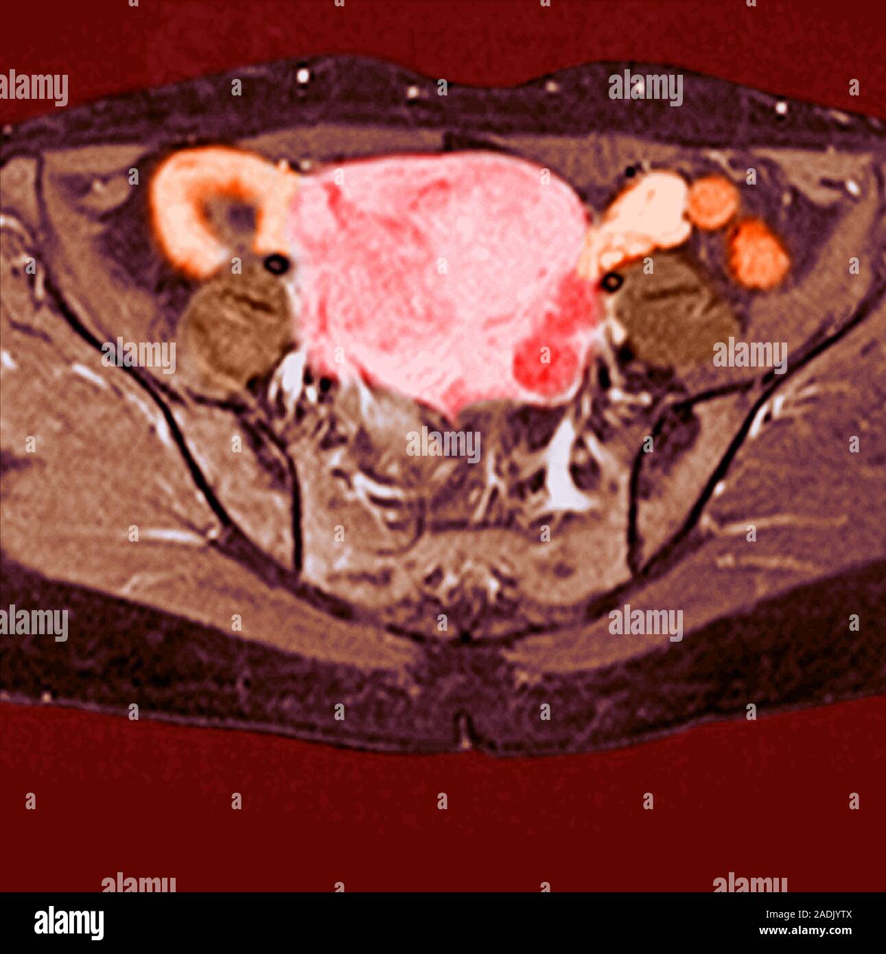 Uterine Fibroid Coloured Magnetic Resonance Imaging Mri Scan Of A Transverse Horizontal