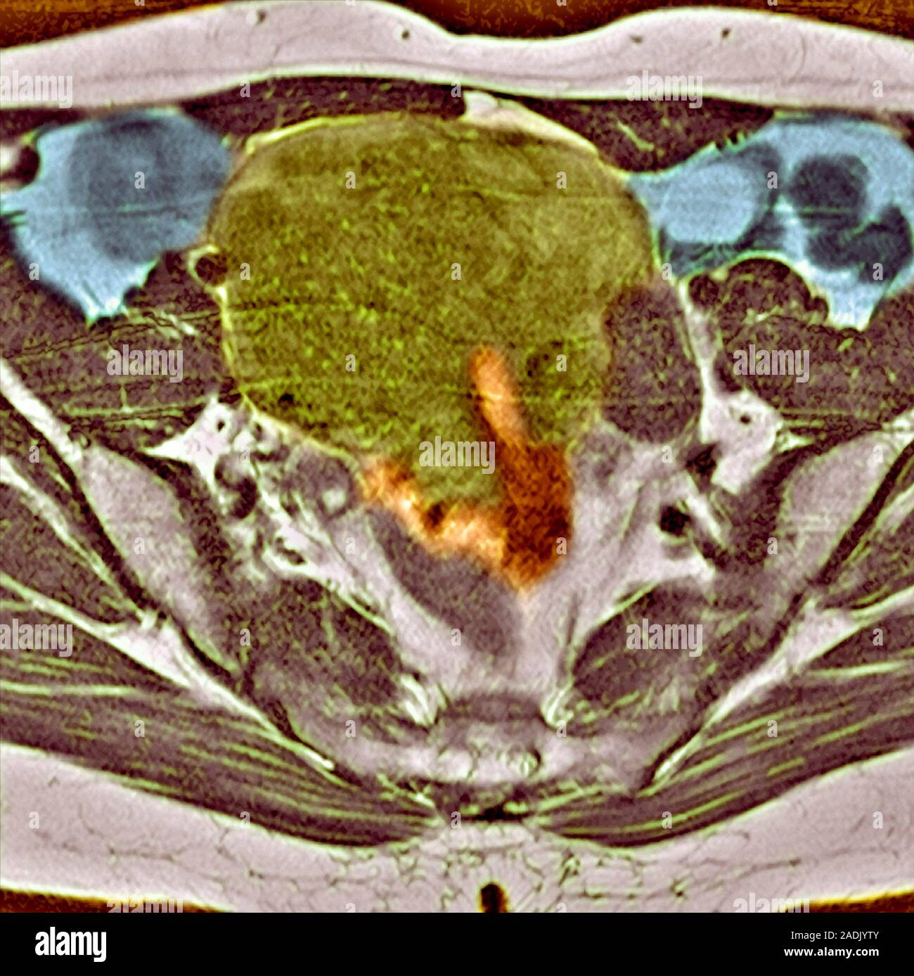 Newcastle Upon Tynescience Photo Library Uterine Fibroid Coloured