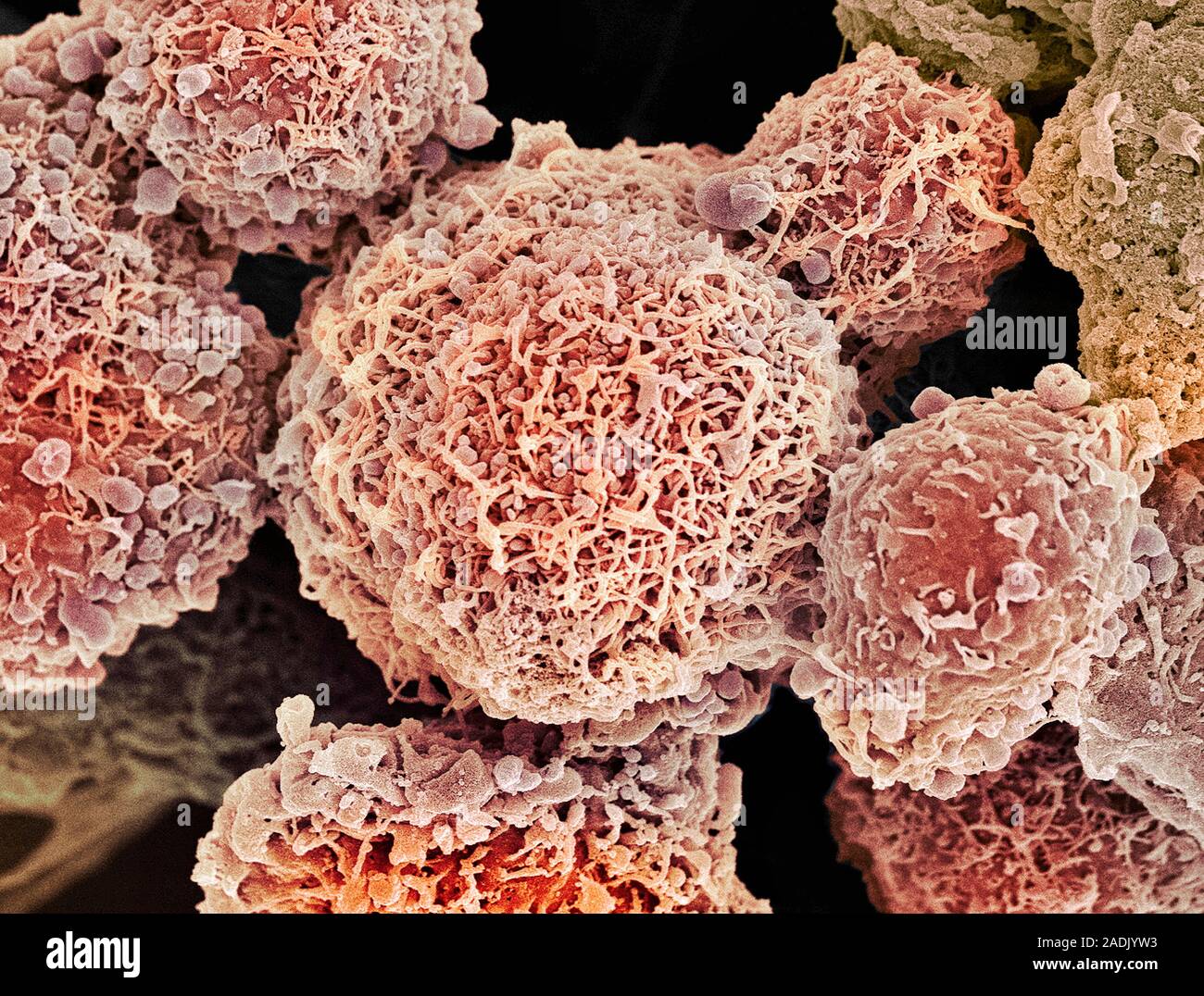 Cervical cancer cells. Coloured scanning electron micrograph (SEM) of ...