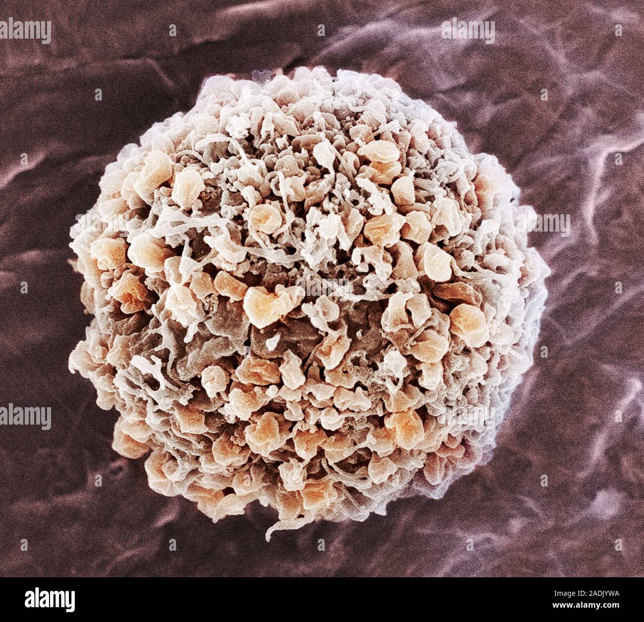 Cervical cancer cell. Coloured scanning electron micrograph (SEM) of a ... Cervical cancer cell. Coloured scanning electron micrograph (SEM) of a ...