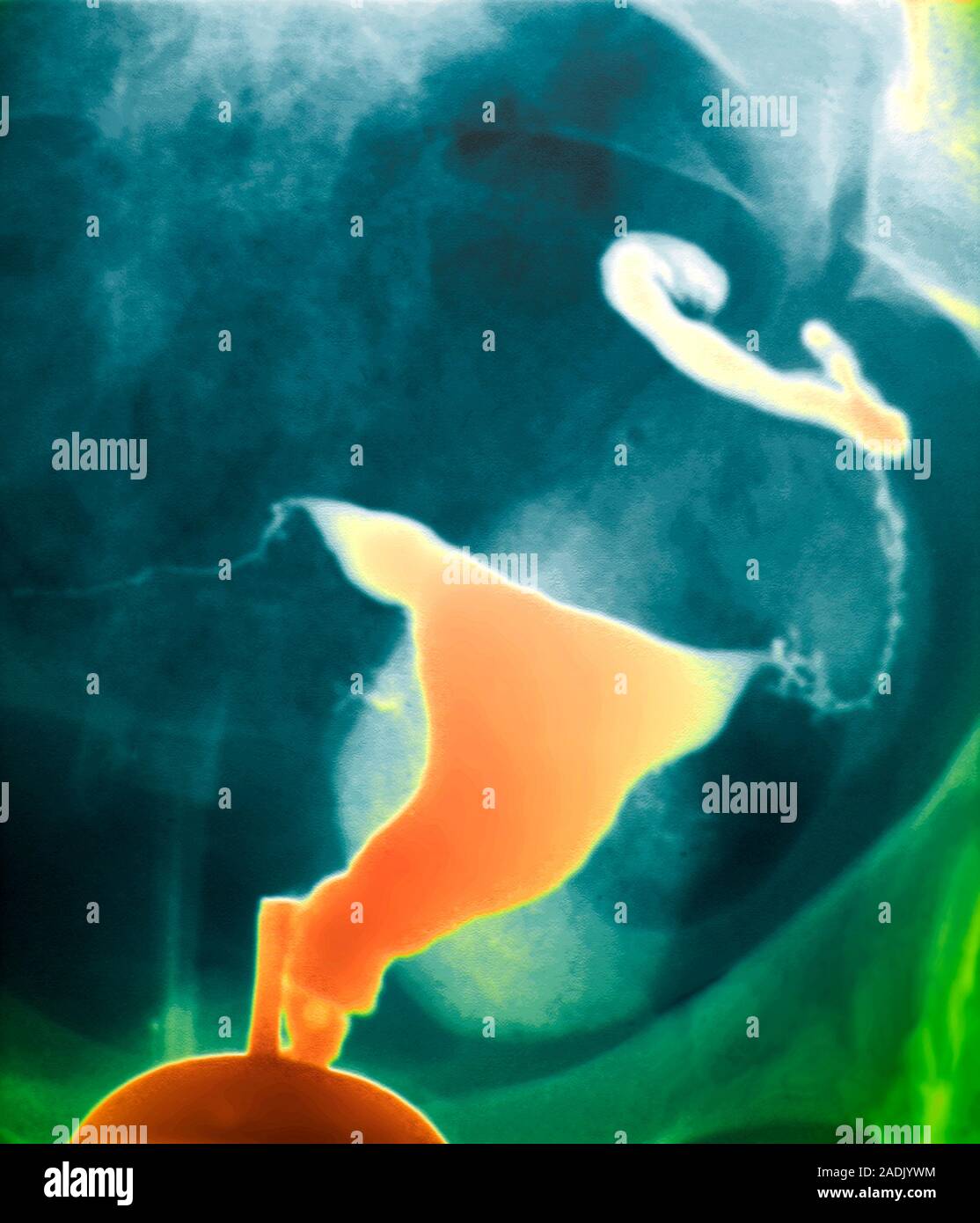 Blocked fallopian tubes. Coloured hystero- salpinogram (X-ray) of the ...