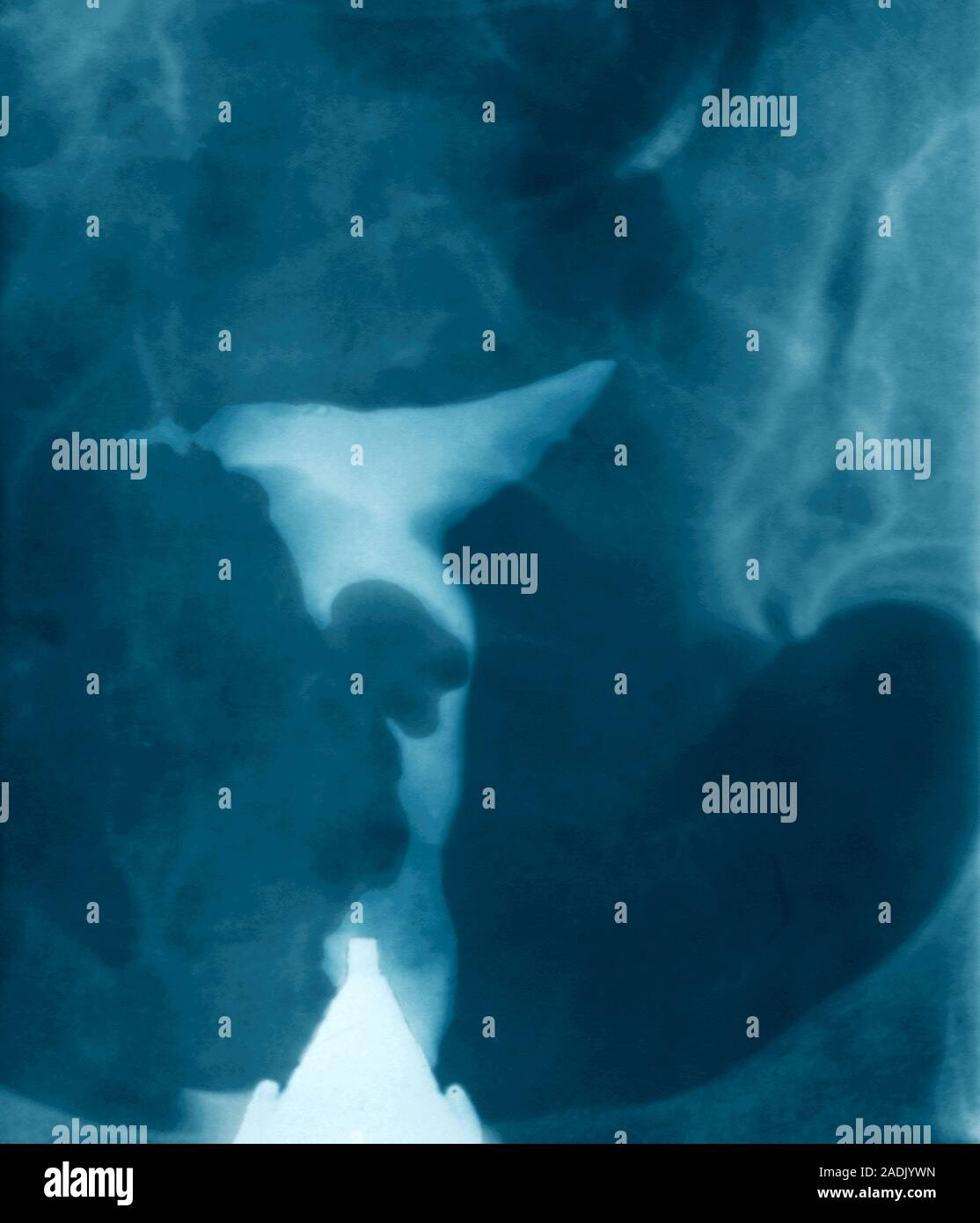 Uterine fibroid. Coloured frontal hysterogram (X- ray) of a woman's ...