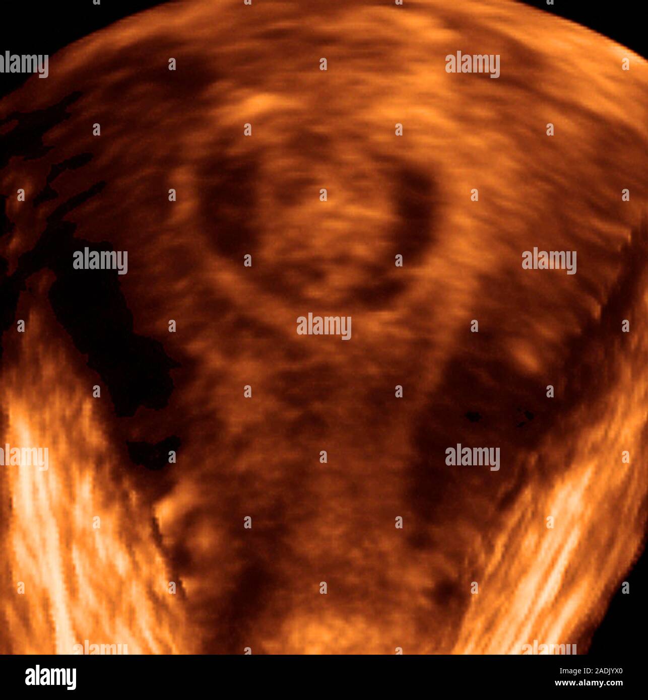 Uterine fibroid. Coloured 3-D ultrasound scan of a submucosal fibroid ...