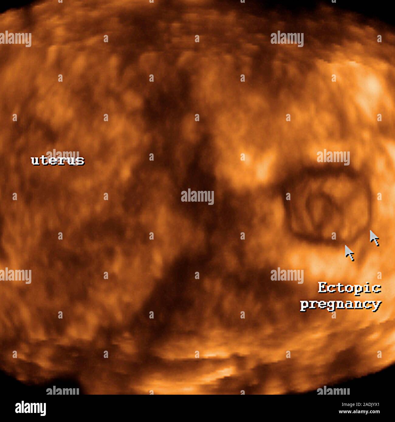 Ectopic pregnancy. Coloured 3-D ultrasound scan of an ectopic pregnancy ...