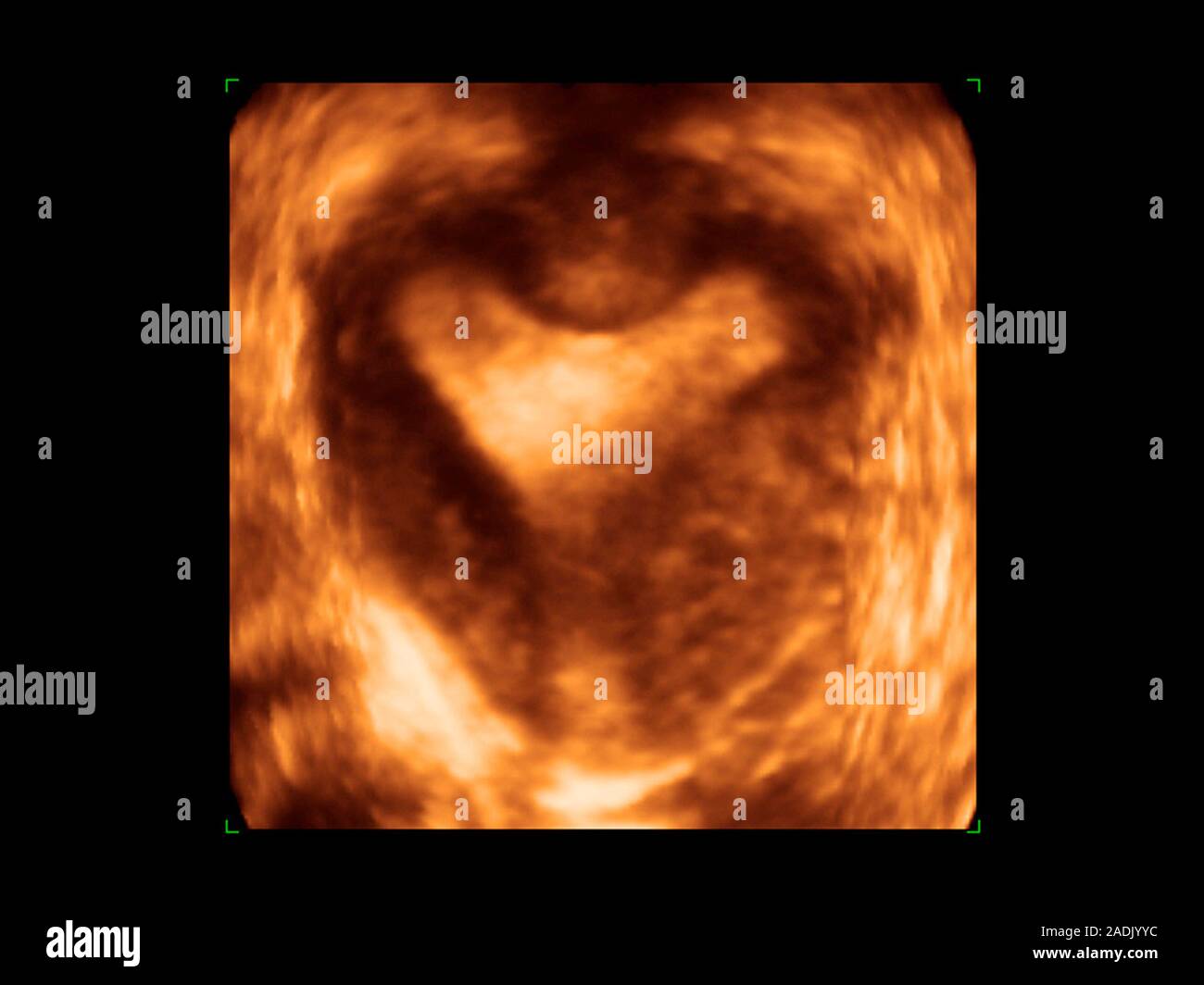 Deformed uterus. Coloured 3-D ultrasound scan of the uterus of a ...
