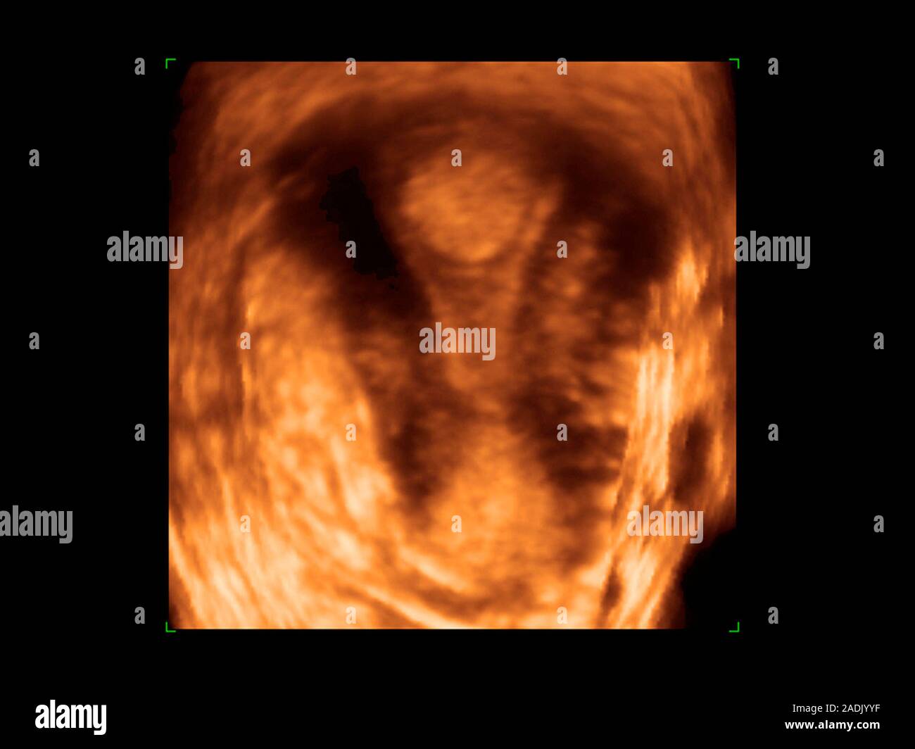 Endometrial polyp. Coloured 3-D ultrasound scan of a polyp (upper ...