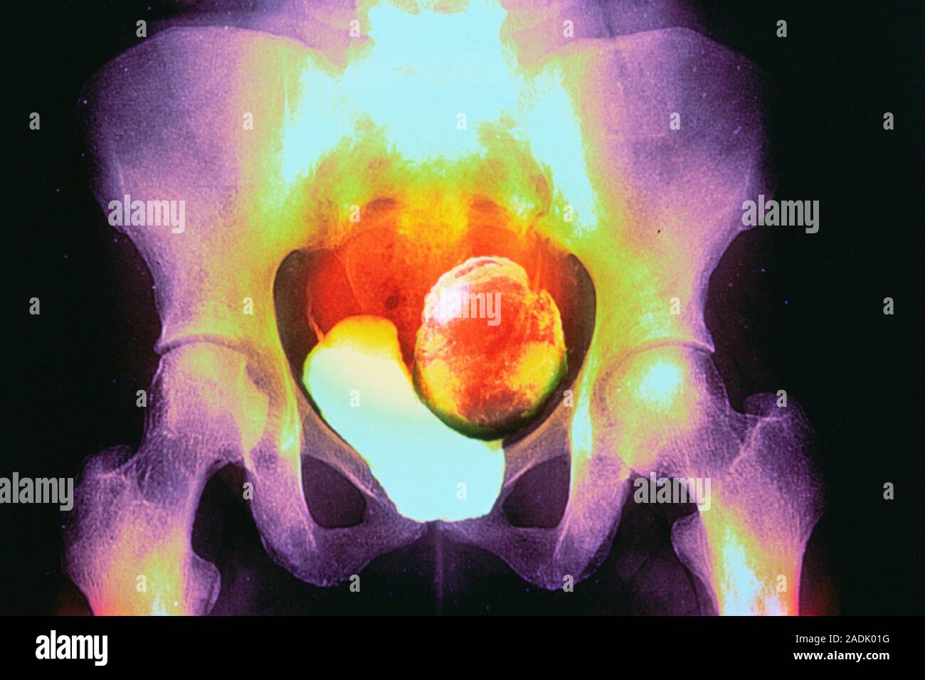 Uterine fibroid. Coloured urogram (X-ray) of the pelvis of a patient ...