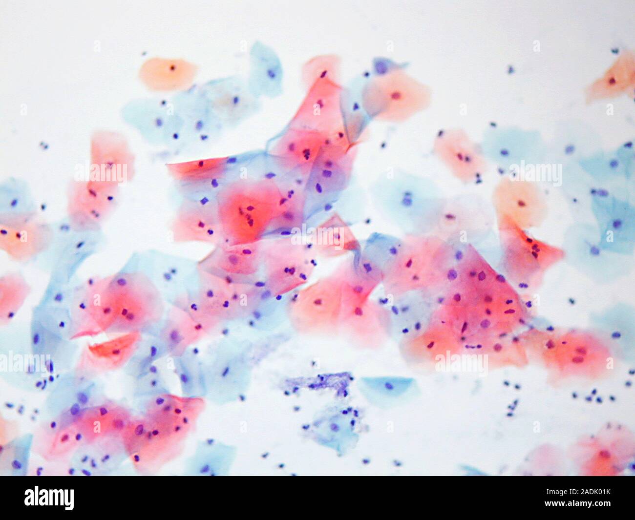 Human papillomavirus infected cervical cells. Light micrograph of cells ...