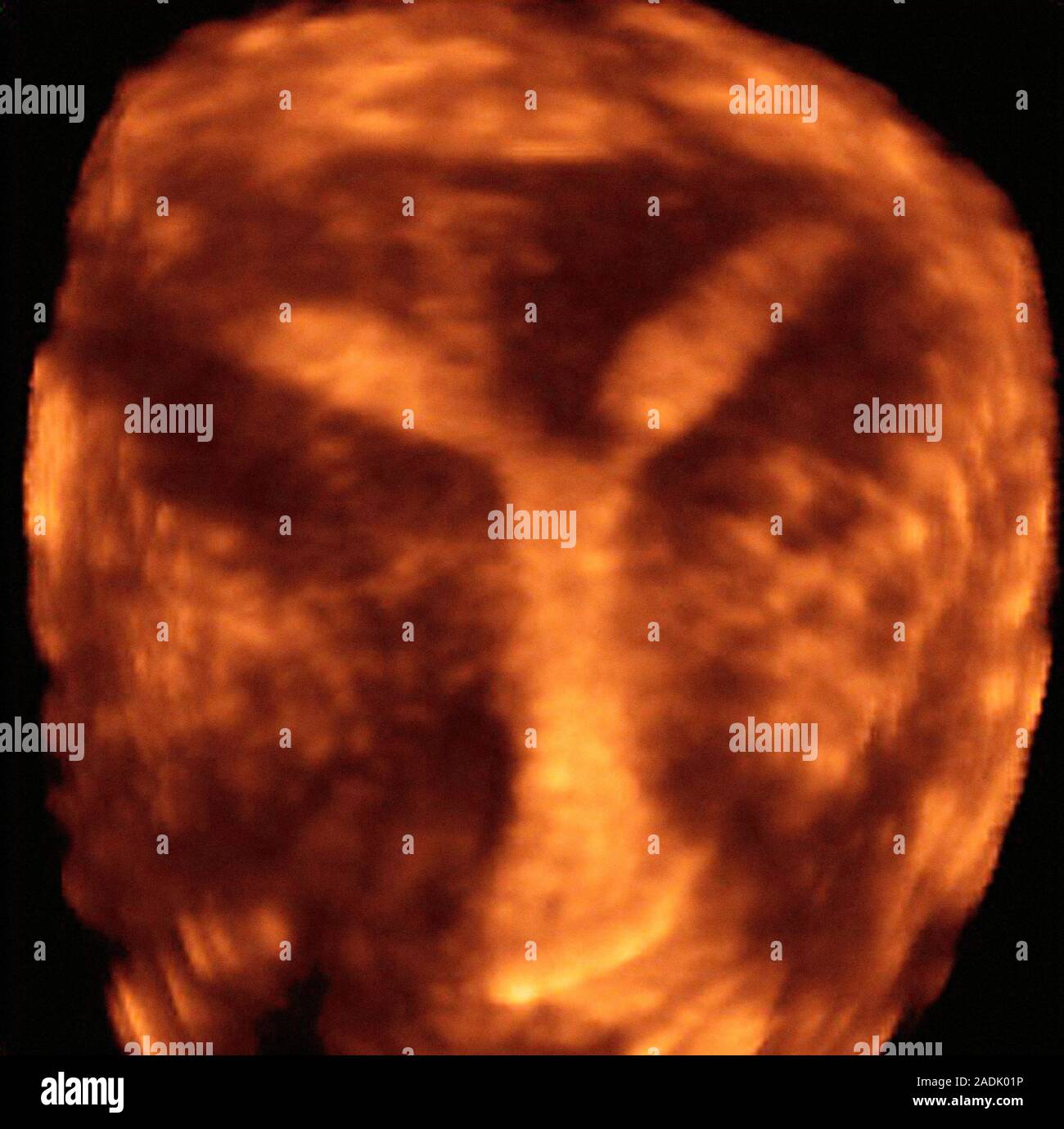 Deformed uterus. Coloured 3-D ultrasound scan of a patient with a ...