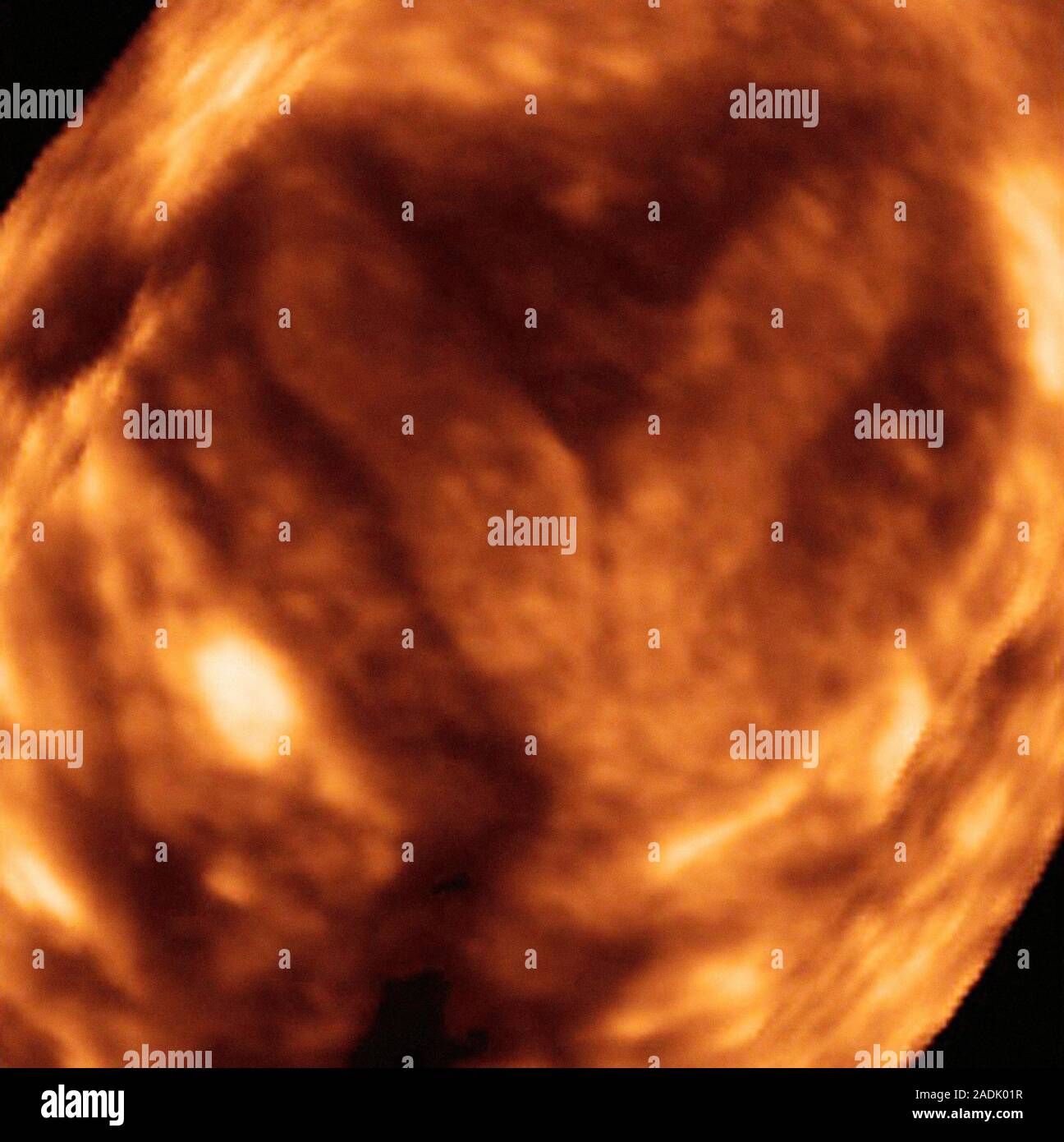 Deformed uterus. Coloured 3-D ultrasound scan of a patient with a ...