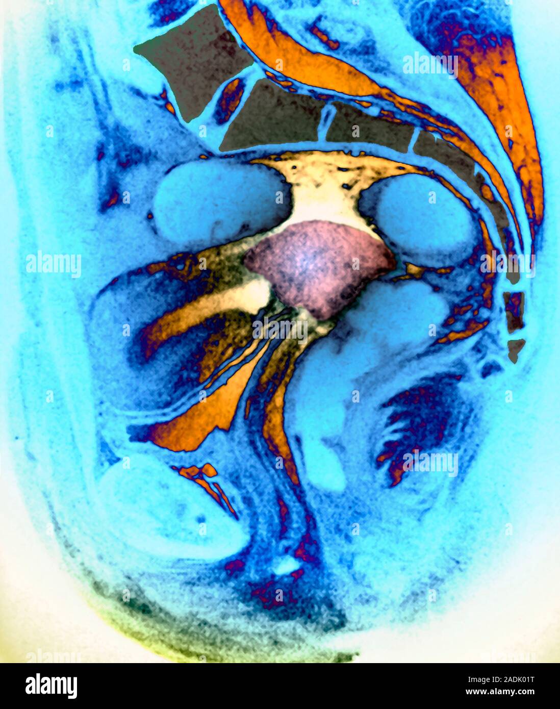 Uterine cancer. Coloured profile magnetic resonance imaging (MRI) scan ...