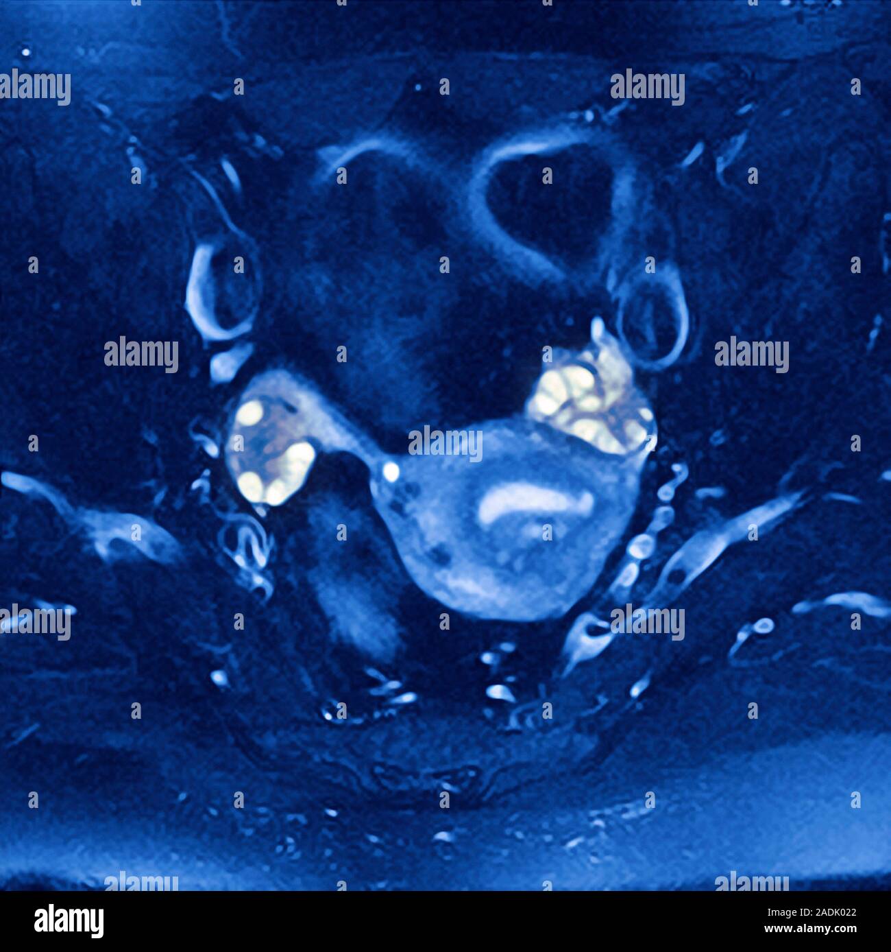 Polycystic ovaries. Magnetic resonance imaging (MRI) scan of a female ...