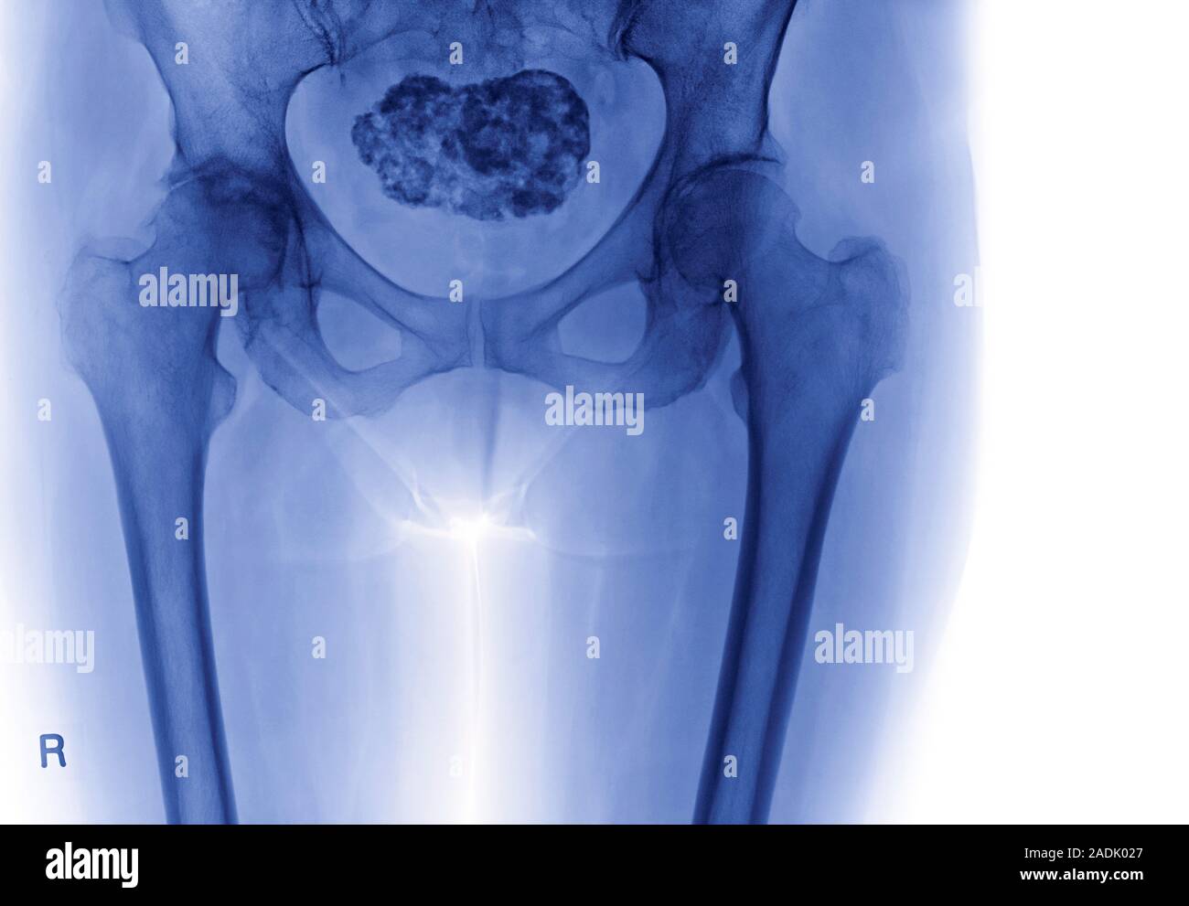 Calcified uterine fibroid. Coloured frontal X-ray of a woman's pelvis ...