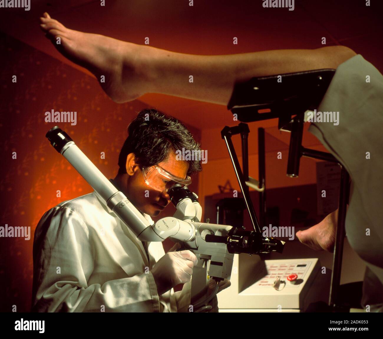 Cervical treatment. Surgeon using a colposcope to direct a laser beam ...