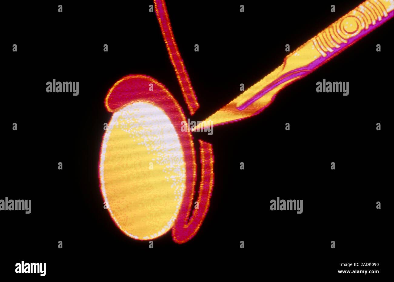 Illustration of a vasectomy, the surgical procedure for sterilisation ...