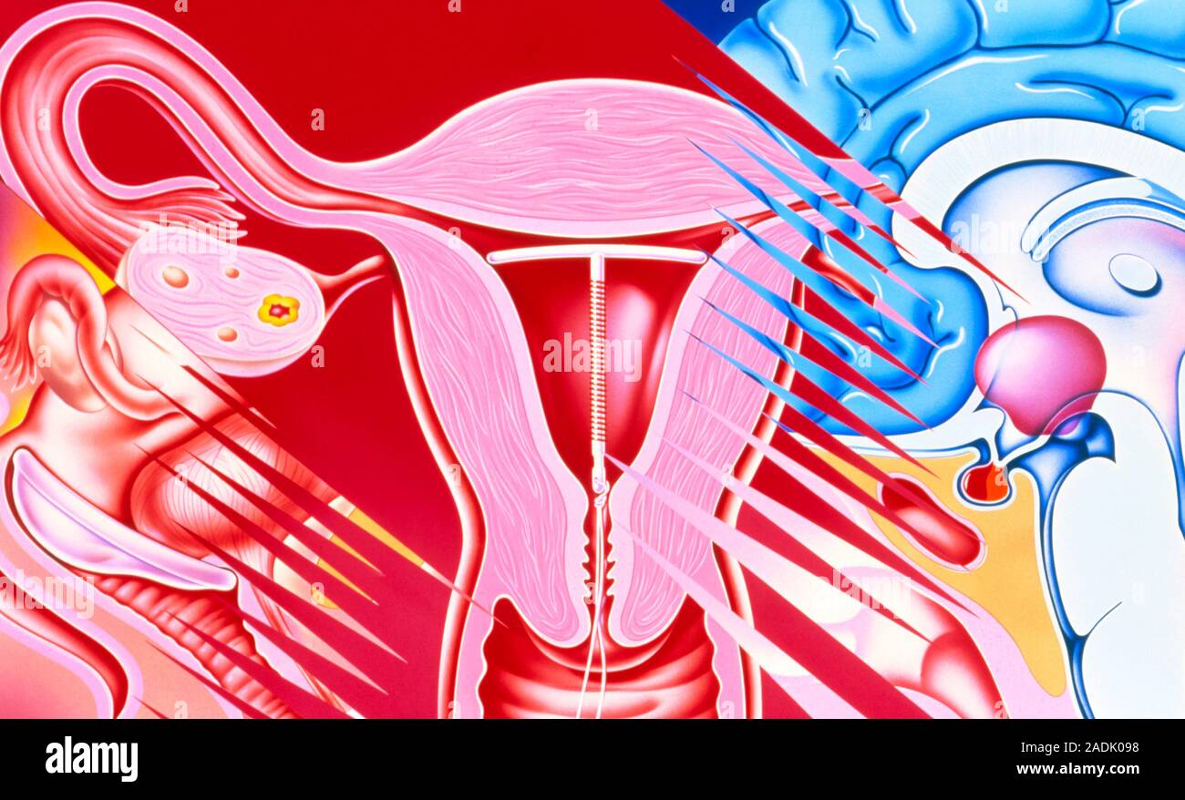 Female contraceptives. Illustration showing three methods of female ...