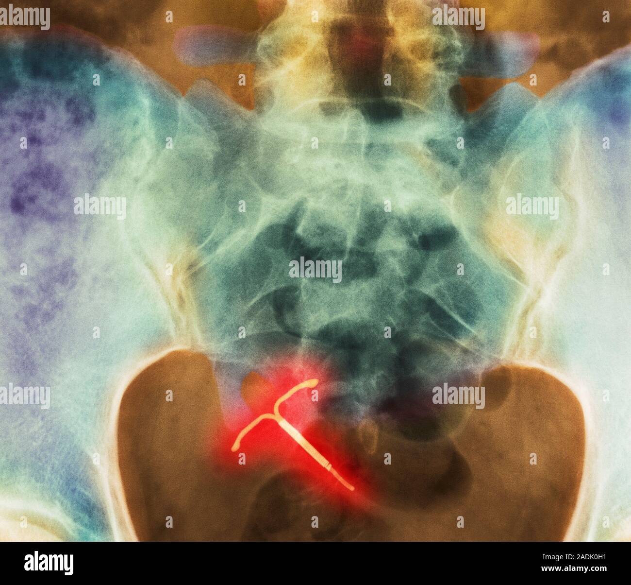 Intrauterine device. Coloured X-ray of an intrauterine device (IUD, red ...