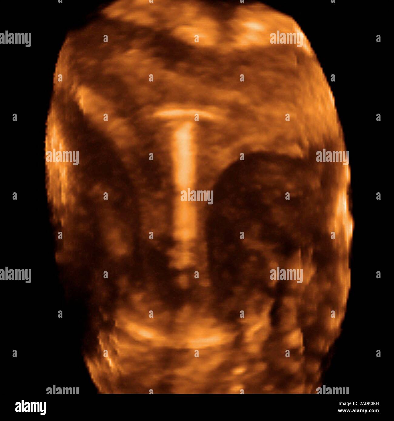 IUD contraceptive. Coloured ultrasound scan of the uterus of a woman ...