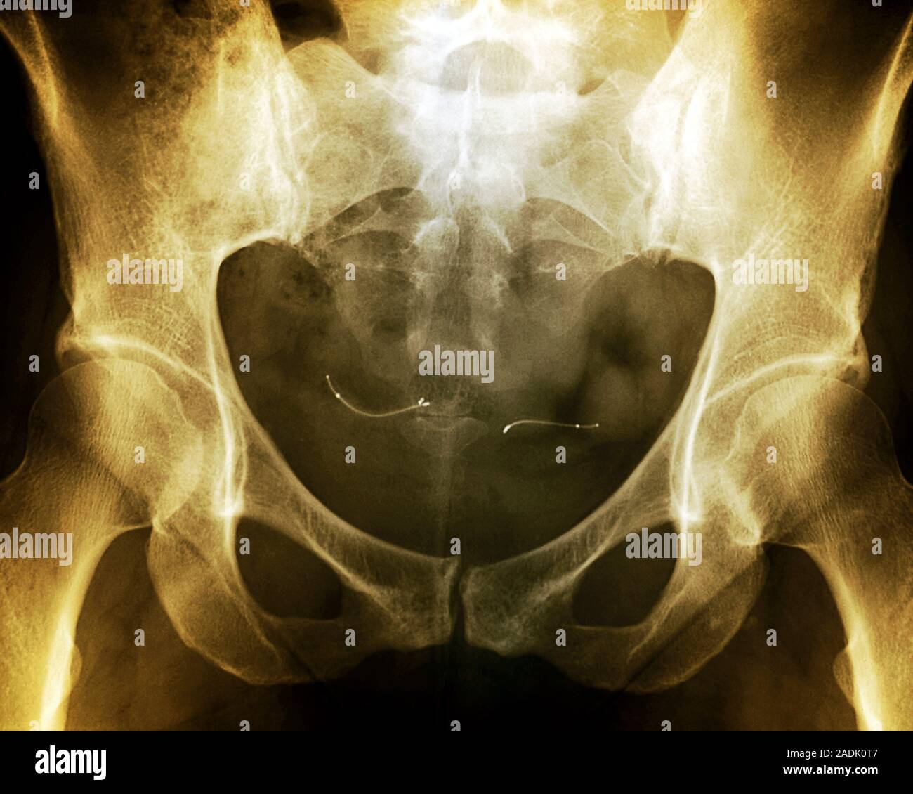 Hysteroscopic sterilisation, coloured X-ray. Frontal view of a 42 year ...