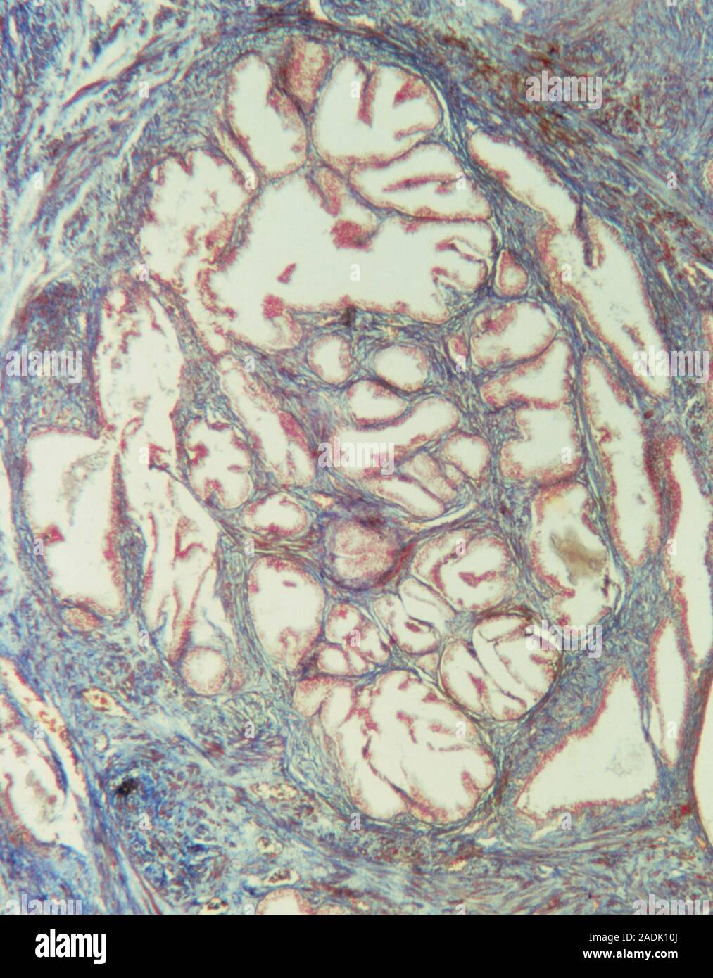 Light micrograph of hypertrophy of the prostate gland. Also known as ...
