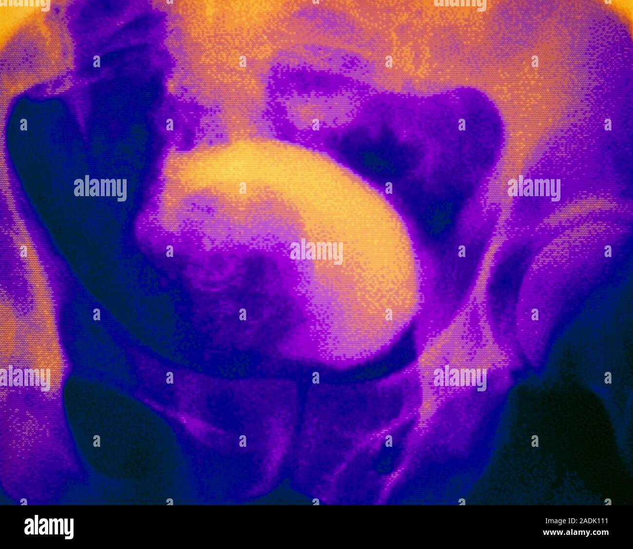Enlarged prostate: false-colour intravenous urogram (IVU) showing an ...