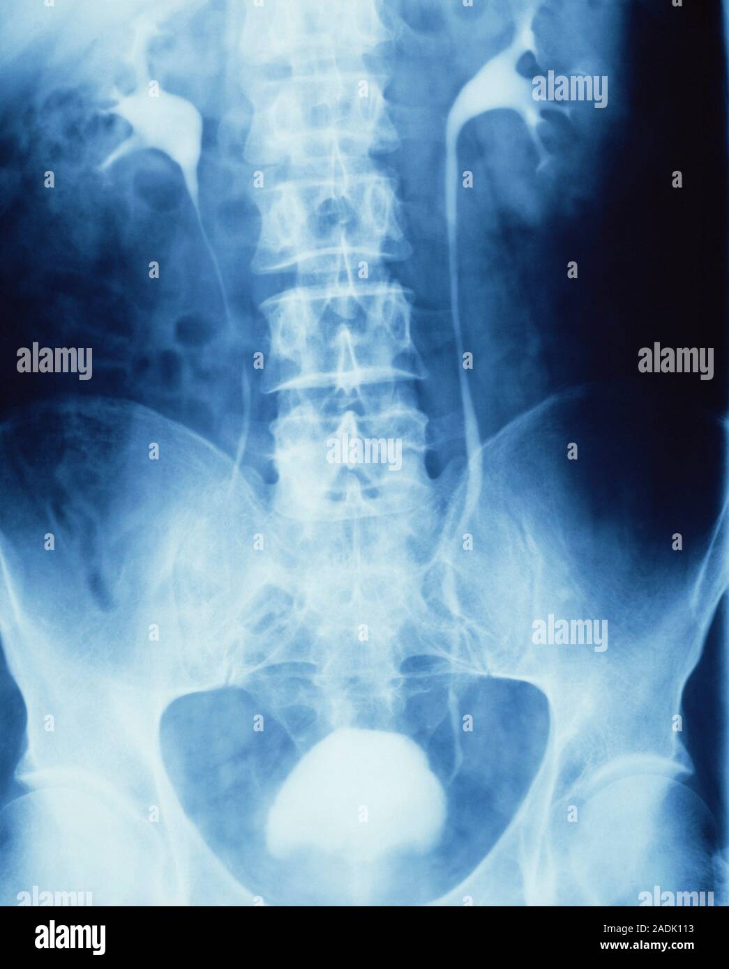Enlarged prostate: Intravenous urogram (IVU) showing an enlarged ...