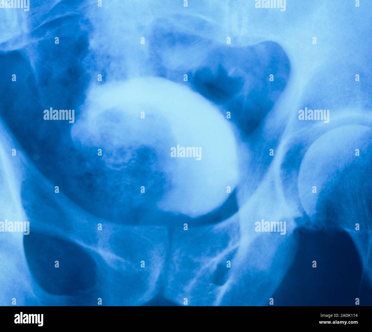 Enlarged prostate: Intravenous urogram (IVU) showing an enlarged ...