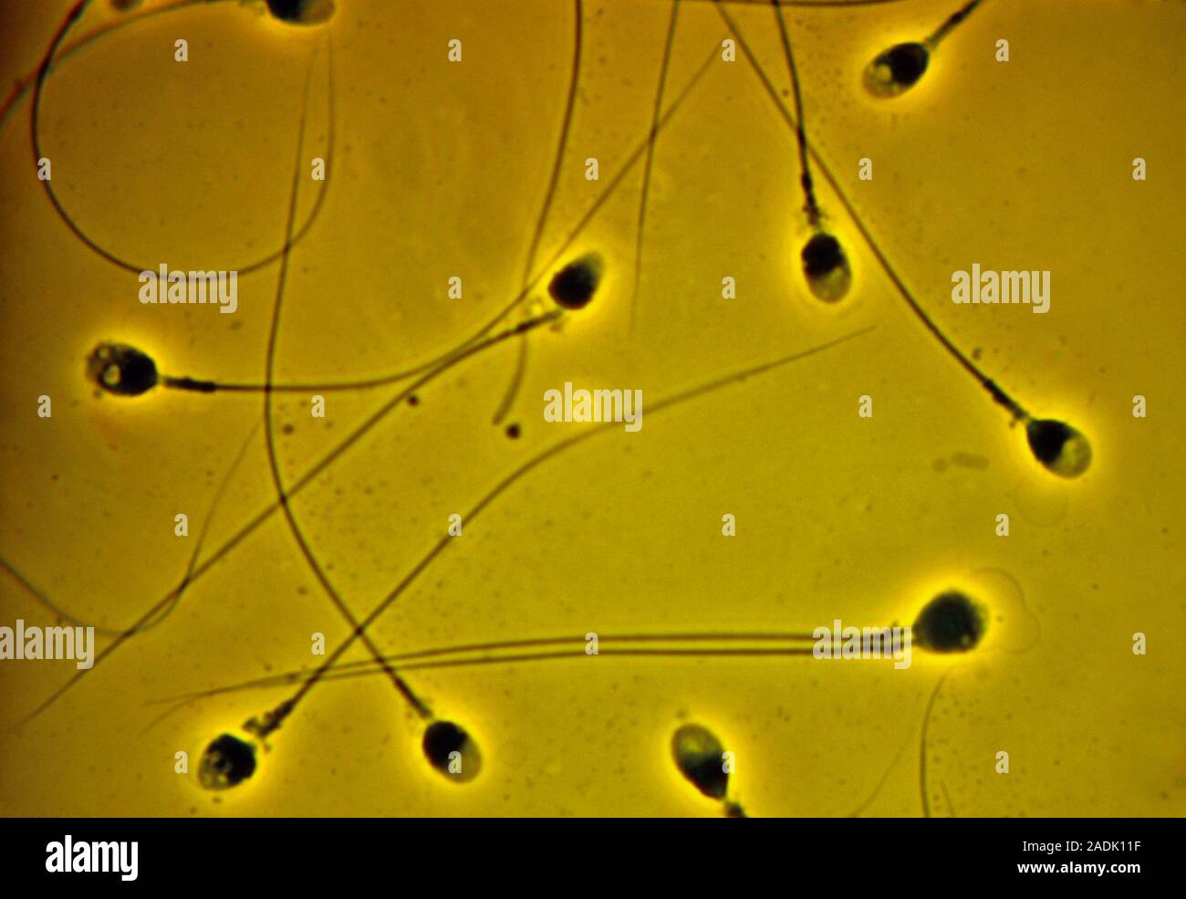 Deformed spermatozoon. Light micrograph showing a deformed spermatozoon ...