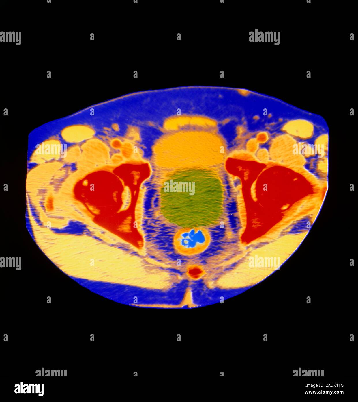 Prostate cancer. Coloured computed tomography (CT) scan of an axial ...