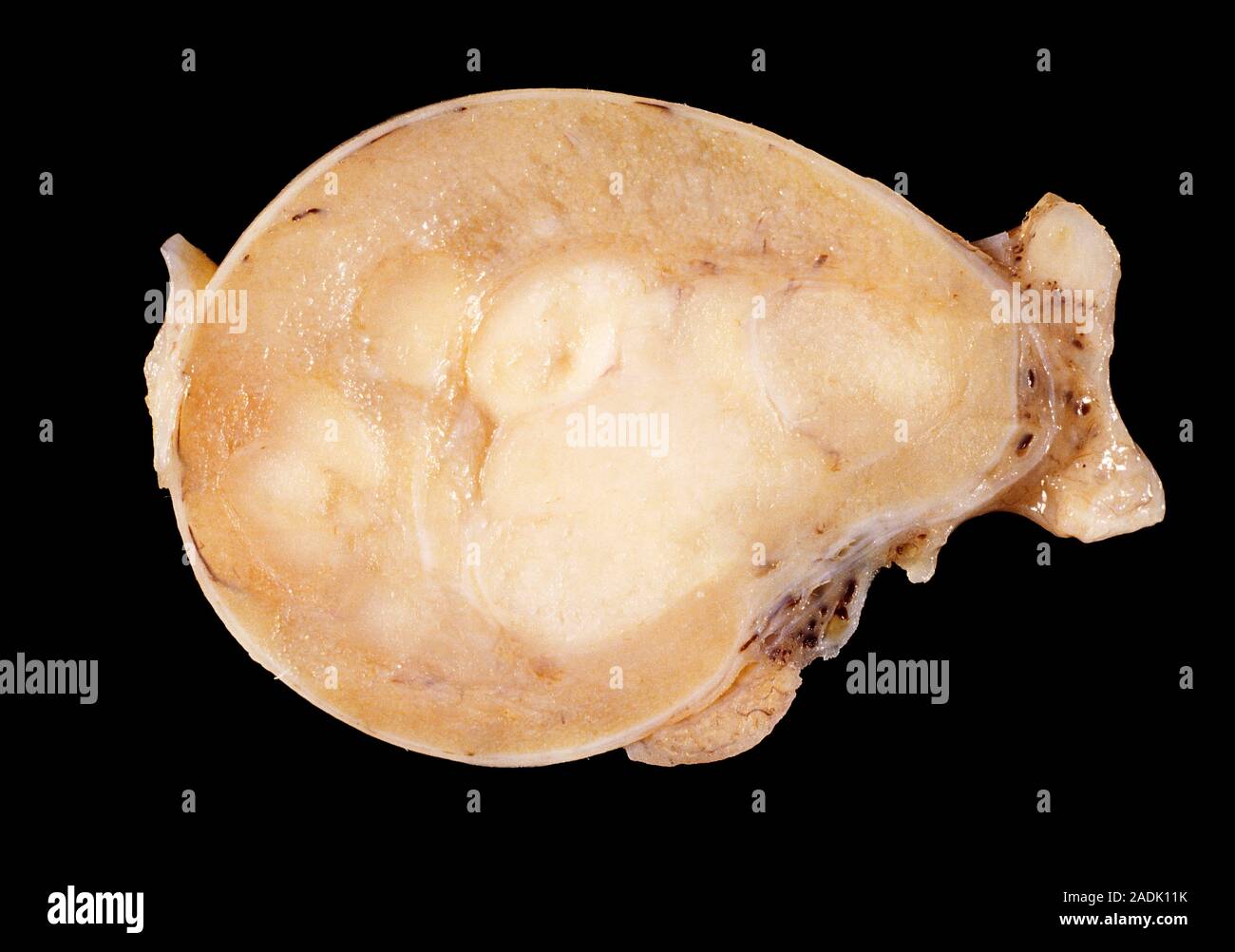 Seminoma. Section through a human testicle showing a seminoma, a ...