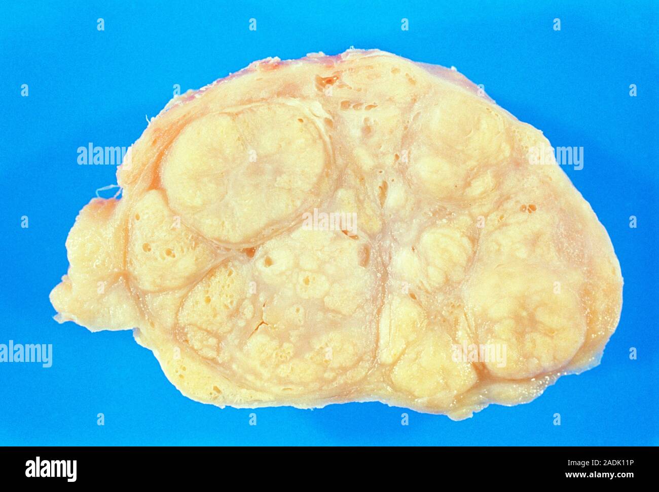 Hyperplastic prostate. Cut specimen of prostate gland exhibiting ...