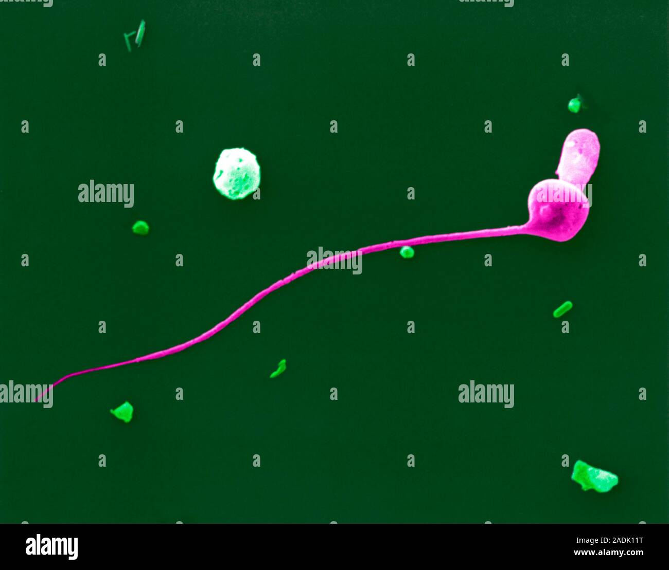Deformed spermatozoon. Coloured scanning electron micrograph showing a ...