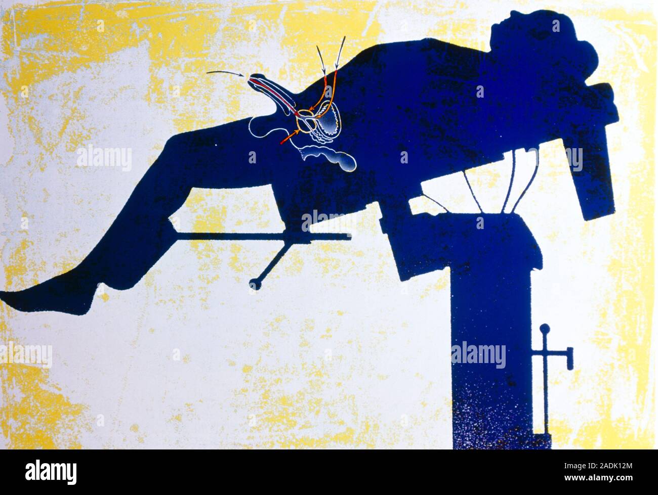 Prostate surgery. Artwork of a man in silhouette on an operating table ...