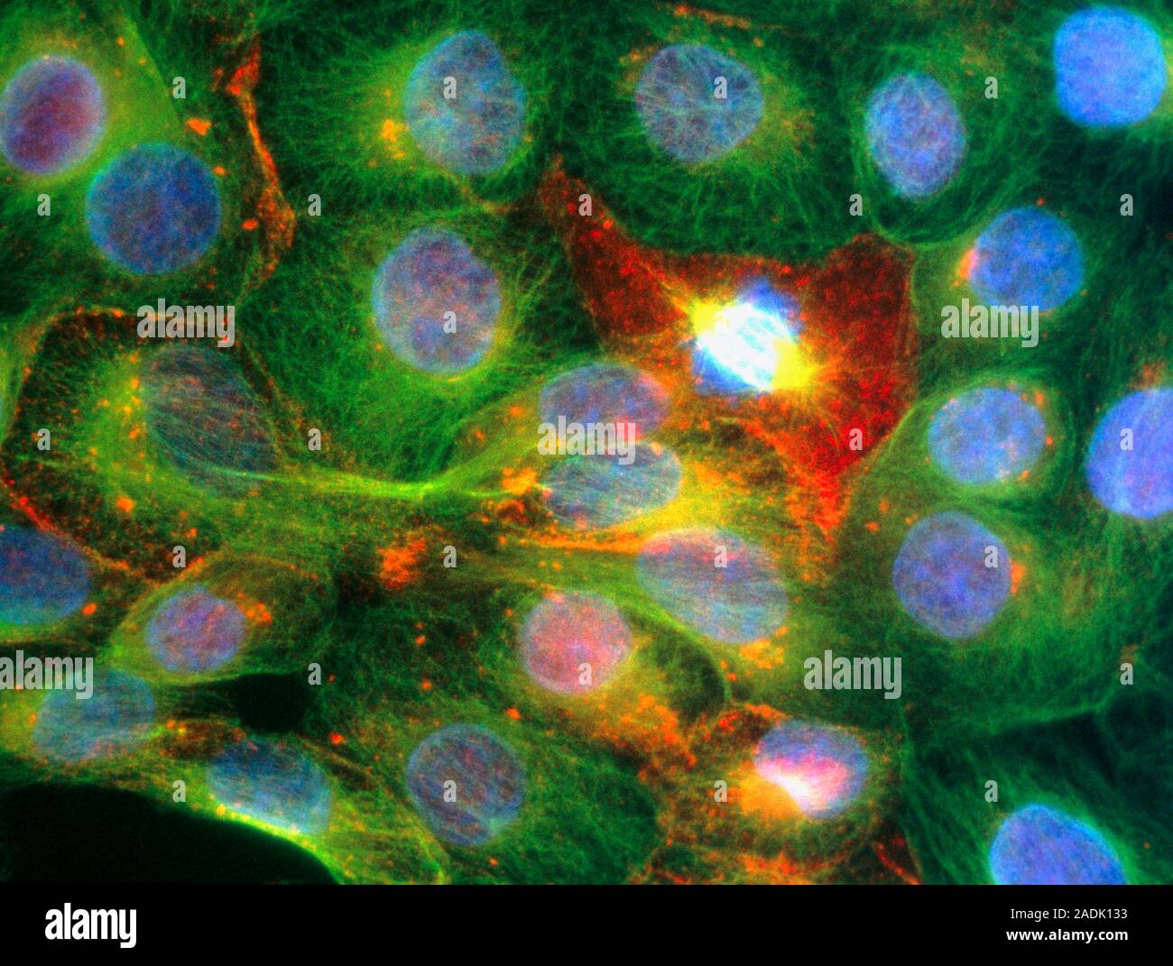 Prostate cancer. Immunofluorescent light micrograph of prostate cancer ...