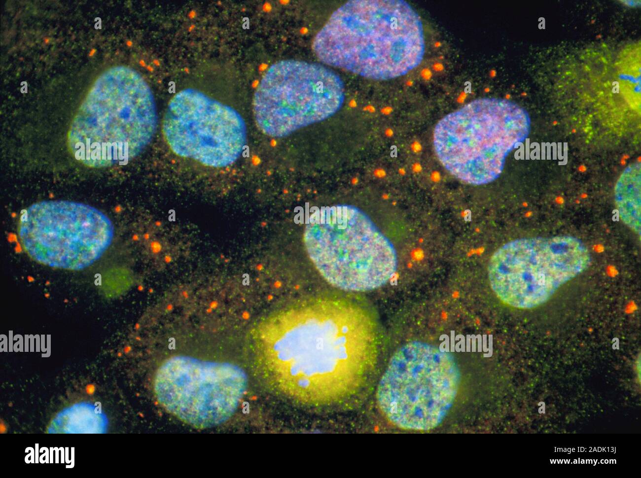 Prostate cancer cells. Immunofluorescent light micrograph of prostate ...