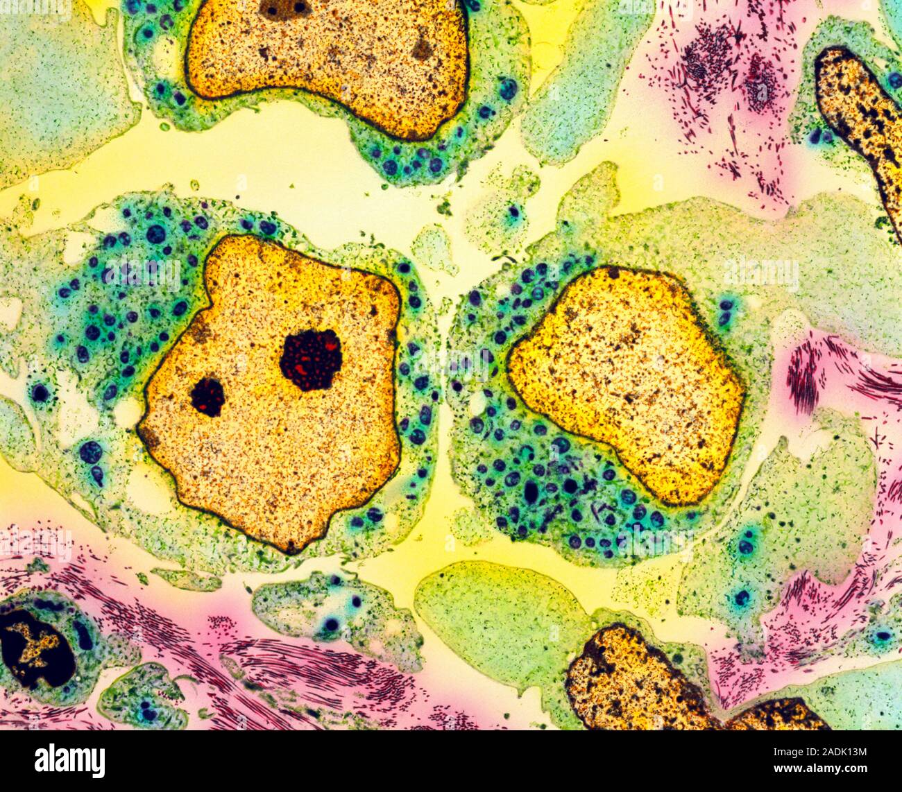Testicular cancer. Coloured transmission electron micrograph (TEM) of a ...