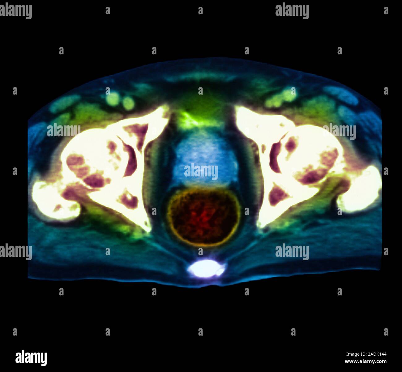 Prostate cancer. Coloured magnetic resonance imaging (MRI) scan of an ...