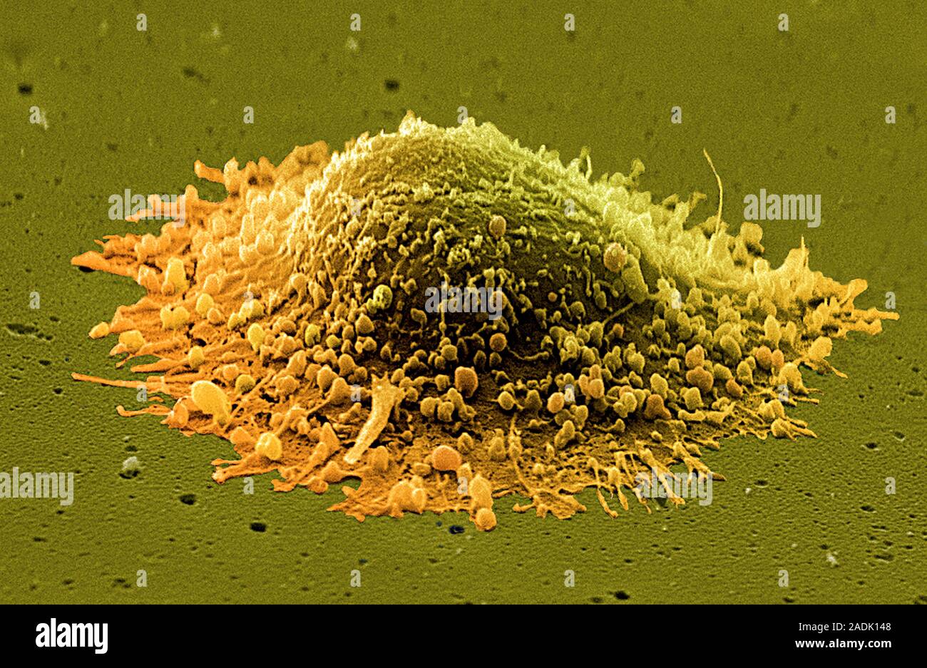 Prostate cancer cell. Coloured scanning electron micrograph (SEM) of a ...