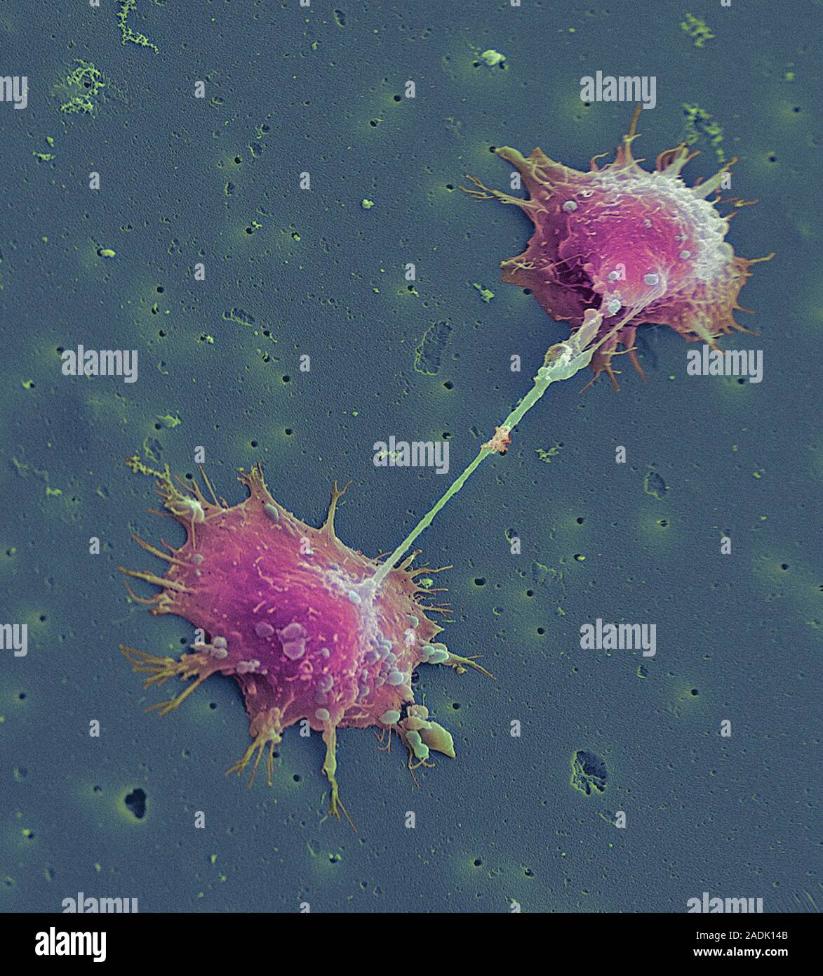 Prostate cancer cells. Coloured scanning electron micrograph (SEM) of ...