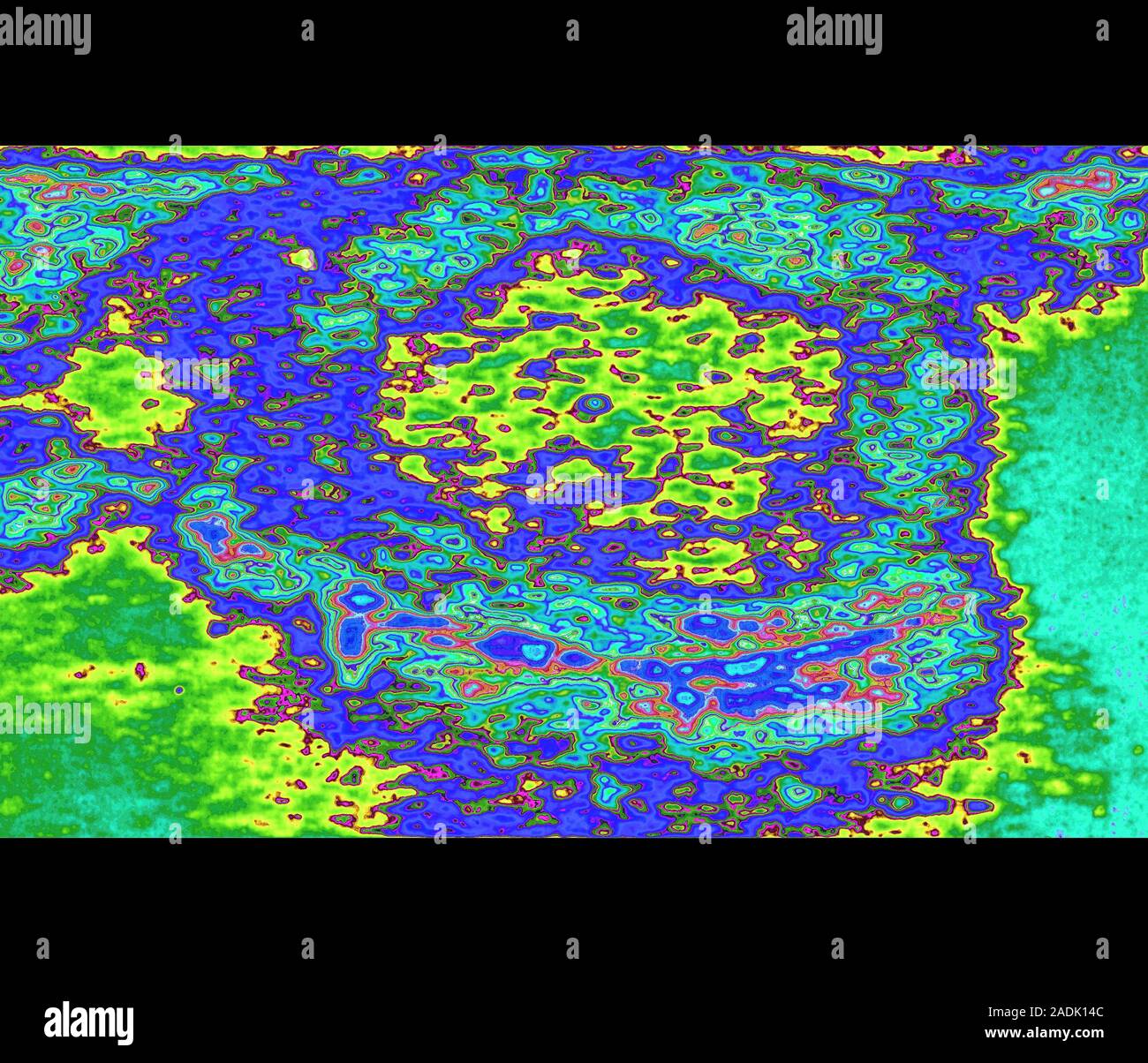 Testicular cancer. Coloured ultrasound scan of a cancer (green, upper ...