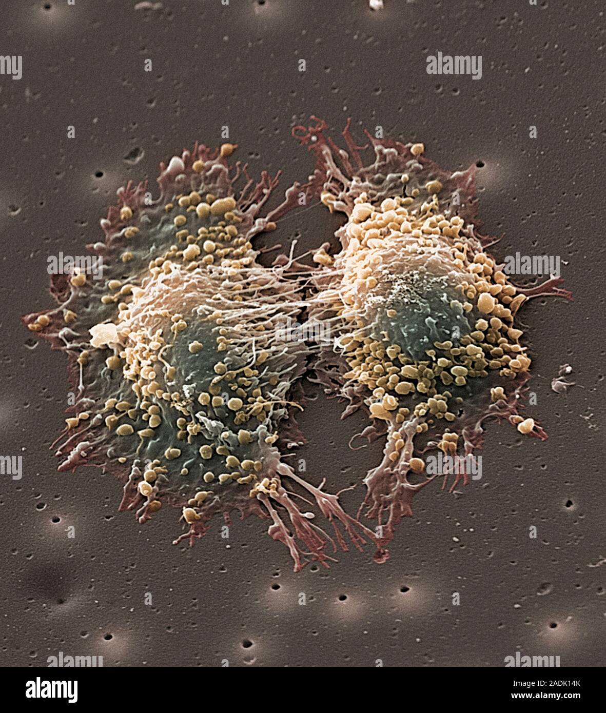Cancer cell division. Coloured scanning electron micrograph (SEM) of ...