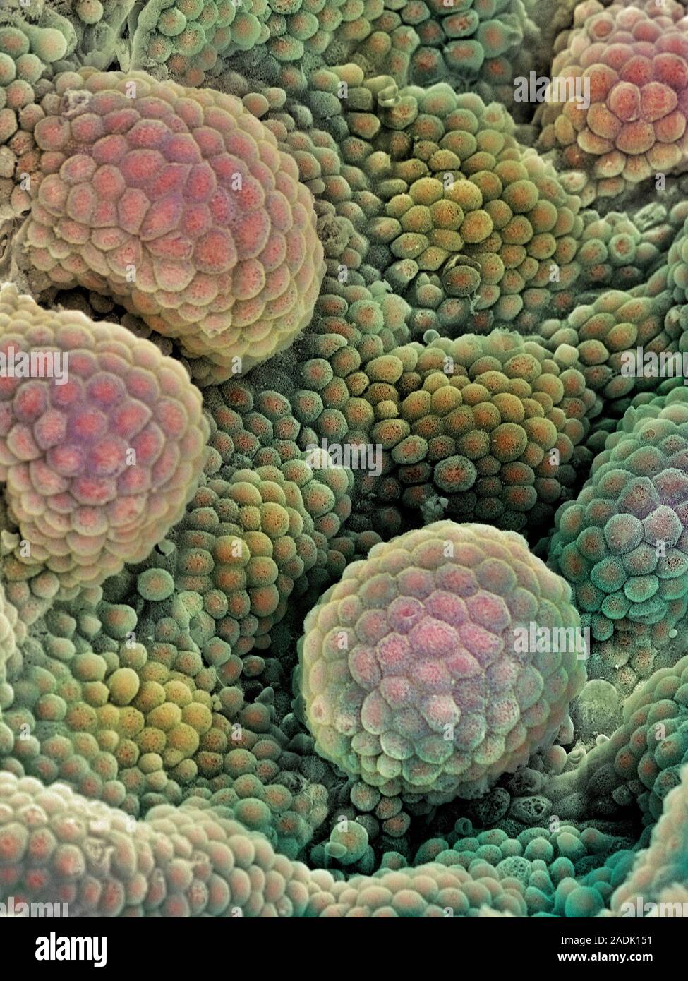 Prostate cancer. Coloured scanning electron micrograph (SEM) of freeze ...