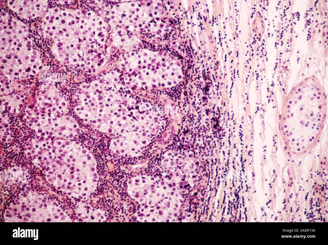 Testicular cancer. Light micrograph of a section through a seminoma ...